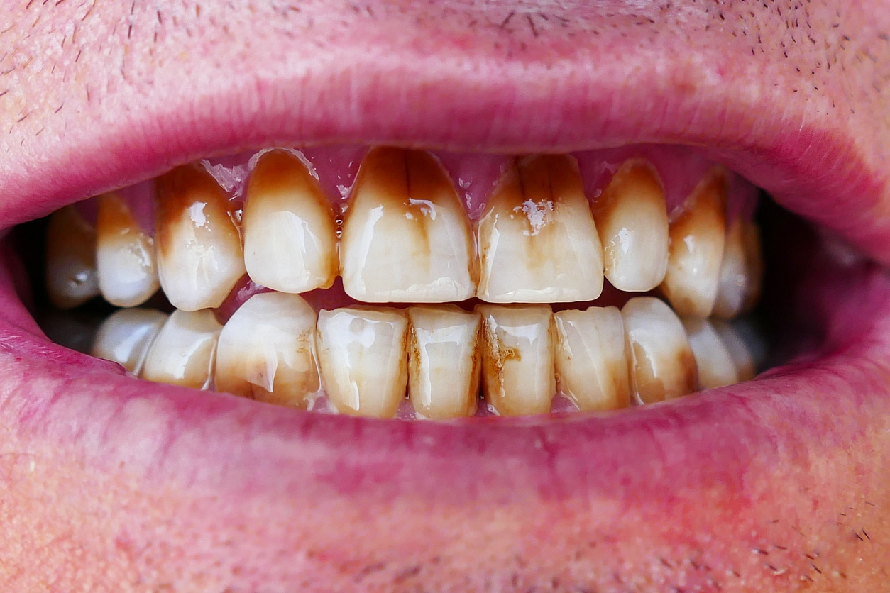 Why Teeth Discoloration Happens | Dr. Tracey Downtown Dental