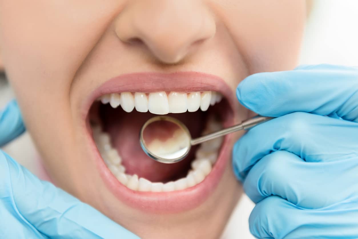 The Stages of Tooth Decay - Dr. Tracey Mulhall